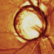 Glaucoma Evaluation and Treatment - Warwar Eye Group