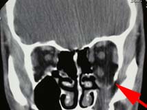 Orbit (Eye Socket) Fractures | Warwar Eye Group