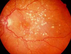Macular Degeneration Evaluation and Treatment | Warwar Eye Group