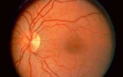 Macular Degeneration Evaluation and Treatment | Warwar Eye Group