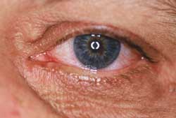 Eyelid Plastic and Reconstructive Surgery | Warwar Eye Group