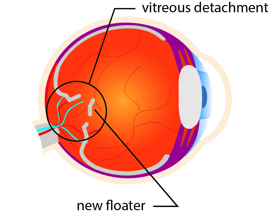 Floaters and Flashes - Warwar Eye Group