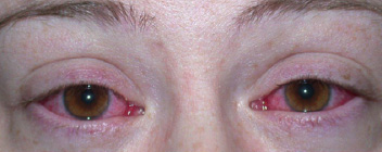 Pink Eye (Conjunctivitis) | Warwar Eye Group