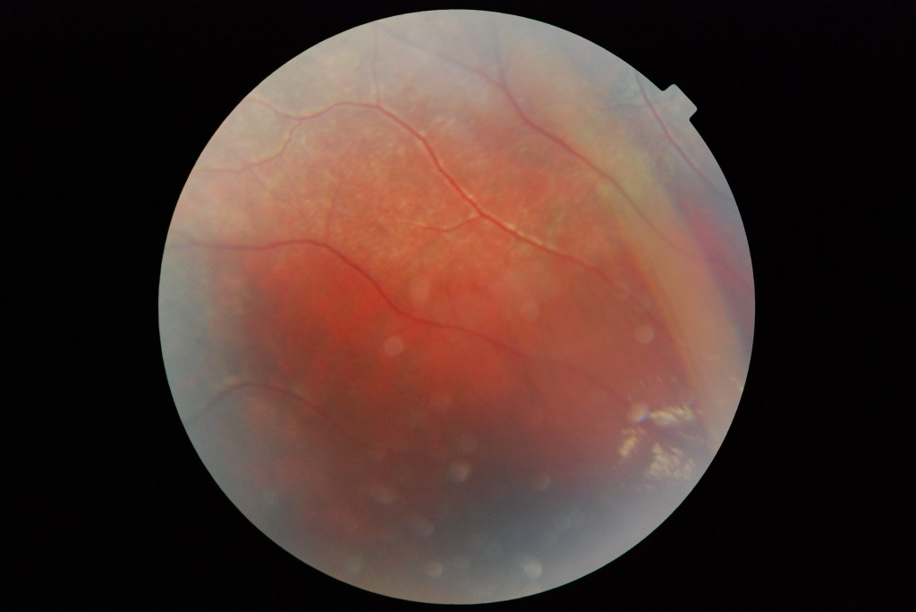 Commotio retinae | Warwar Eye Group