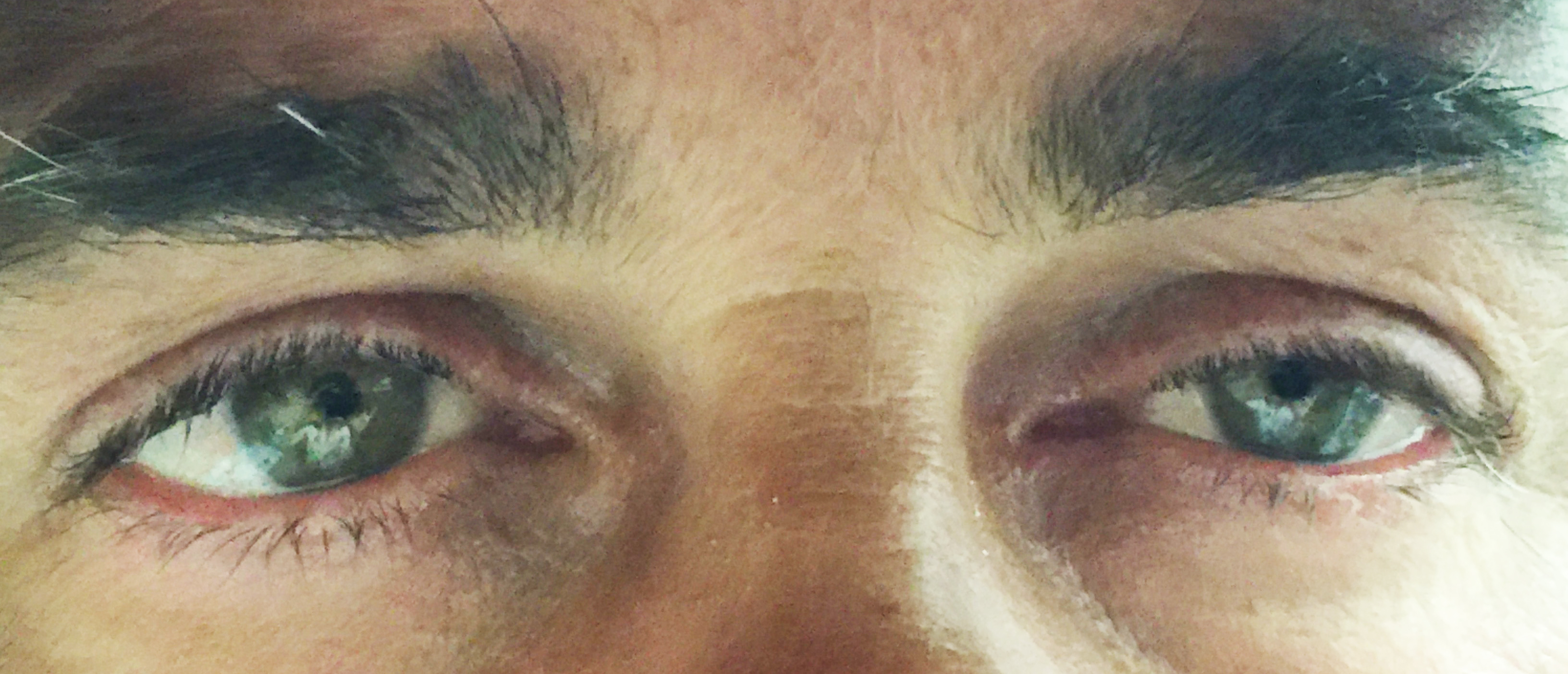 Photokeratitis - Warwar Eye Group