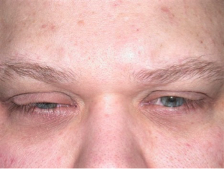 Floppy Eyelid Syndrome | Warwar Eye Group