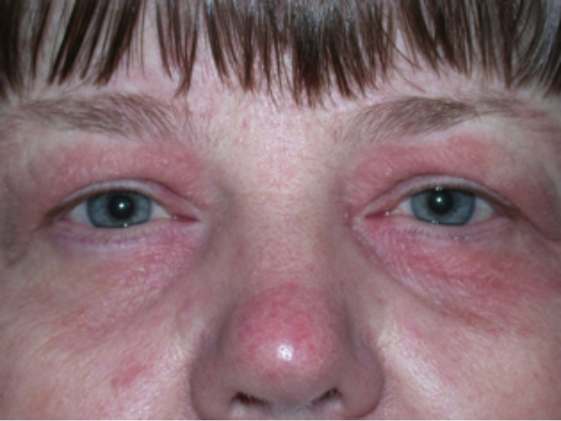 Eyelid Dermatitis - Warwar Eye Group