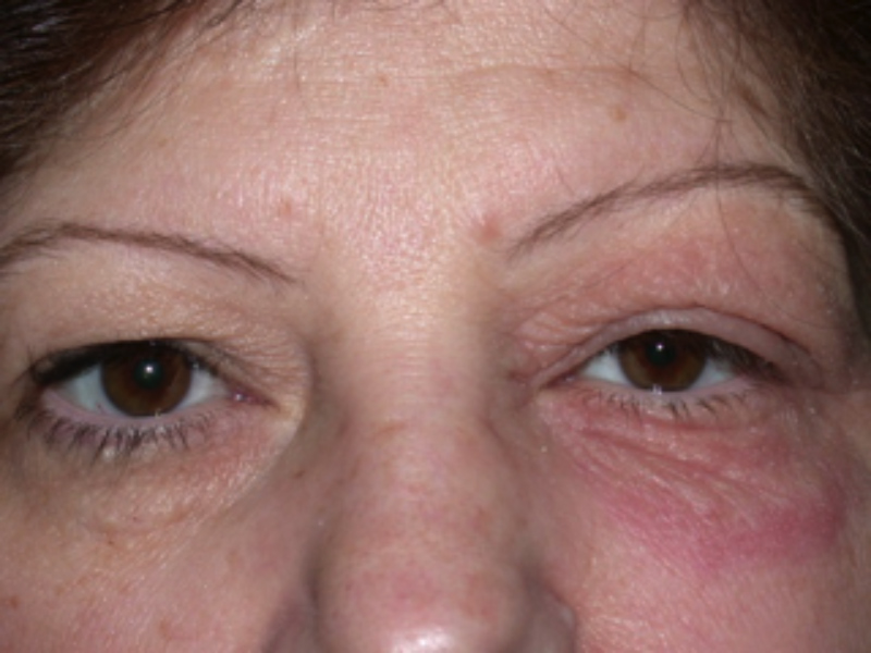 Eyelid Dermatitis - Warwar Eye Group