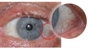 Subconjunctival Hemorrhage - Warwar Eye Group