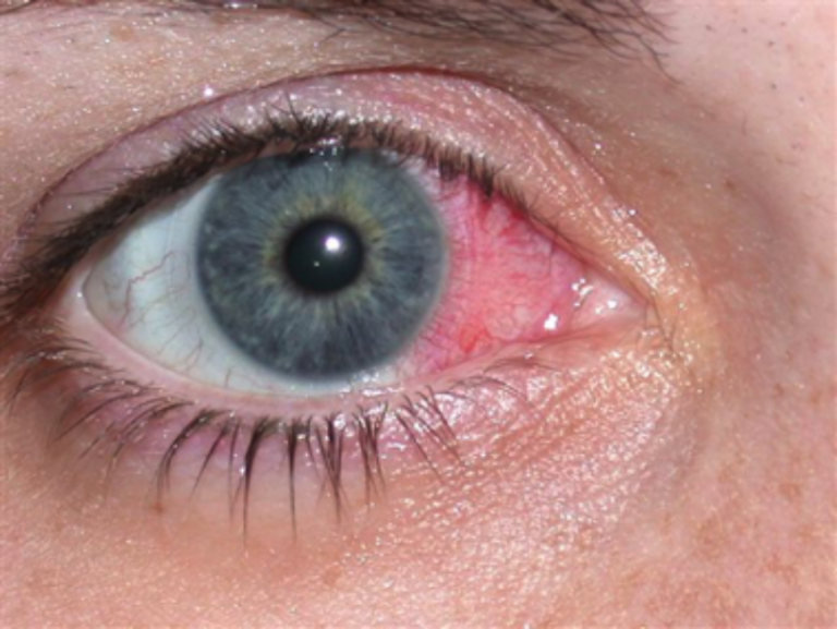 Episcleritis | Warwar Eye Group