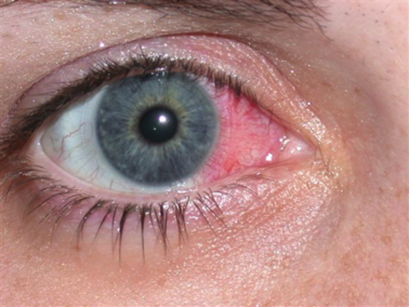 Episcleritis | Warwar Eye Group