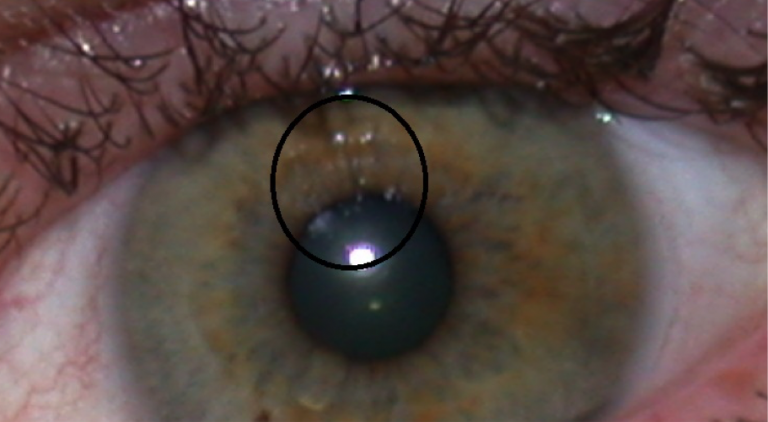 Corneal Erosion | Warwar Eye Group