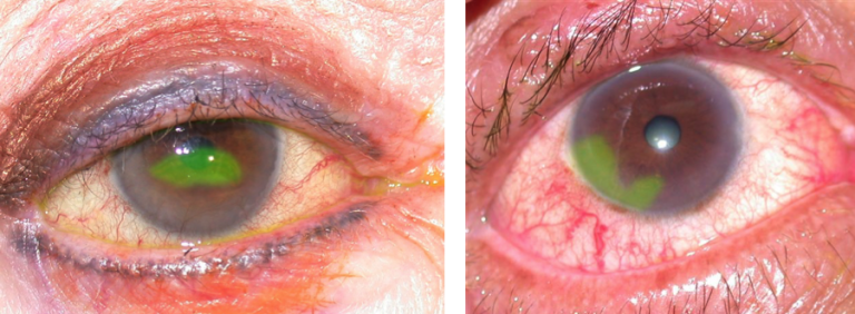 Corneal Abrasions﻿ - Warwar Eye Group