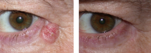 Eyelid Basal Cell Carcinoma - Warwar Eye Group