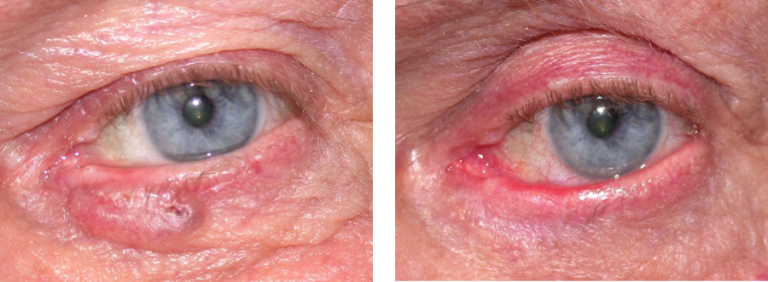 Eyelid Basal Cell Carcinoma | Warwar Eye Group