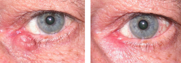 Eyelid Basal Cell Carcinoma - Warwar Eye Group
