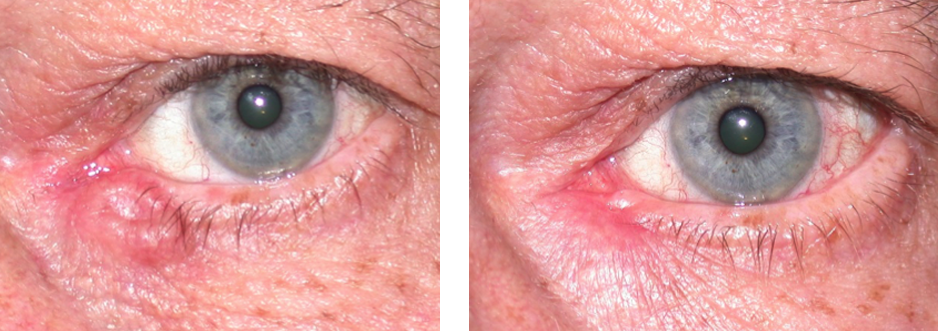 Eyelid Basal Cell Carcinoma - Warwar Eye Group