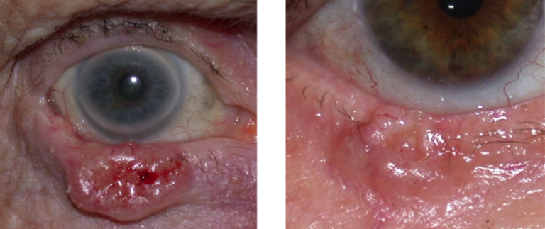 Eyelid Basal Cell Carcinoma - Warwar Eye Group