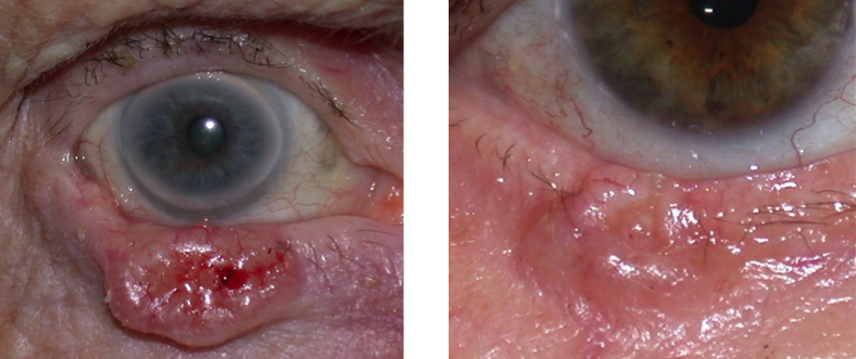Early Basal Cell Carcinoma Eyelid