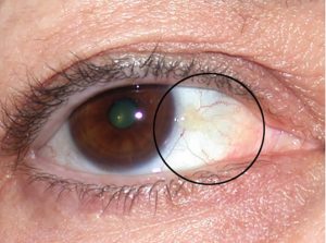 Pinguecula - Warwar Eye Group