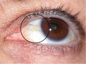 Pinguecula - Warwar Eye Group