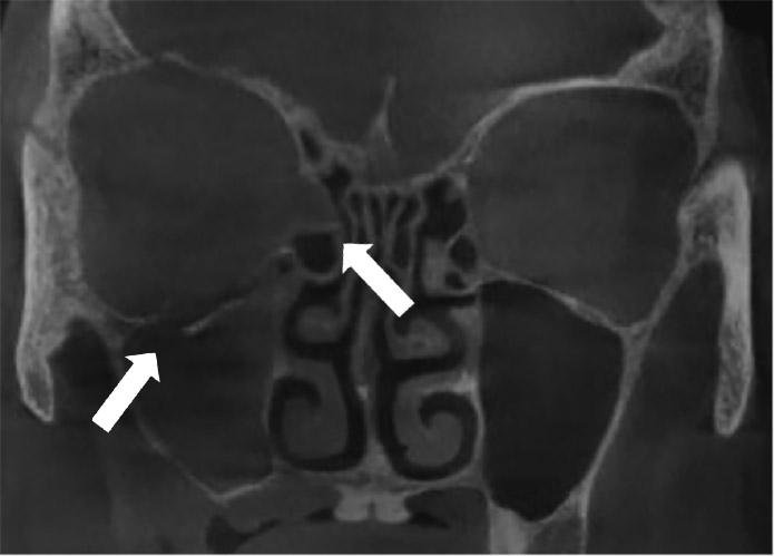 Orbit (Eye Socket) Fractures | Warwar Eye Group
