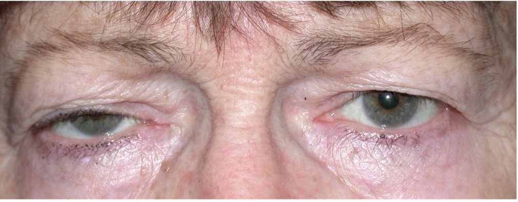 Horner’s Syndrome - Warwar Eye Group