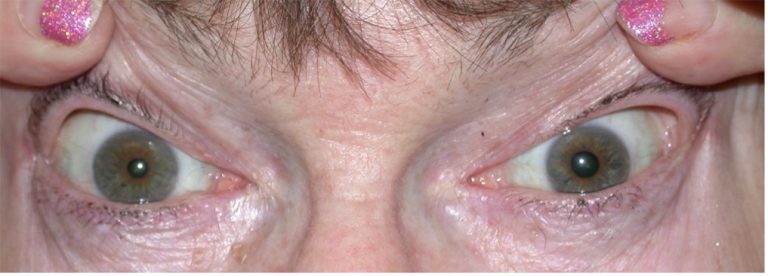 Horner’s Syndrome - Warwar Eye Group