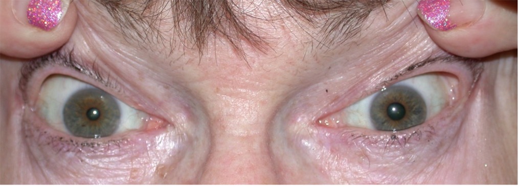 Horner’s Syndrome - Warwar Eye Group