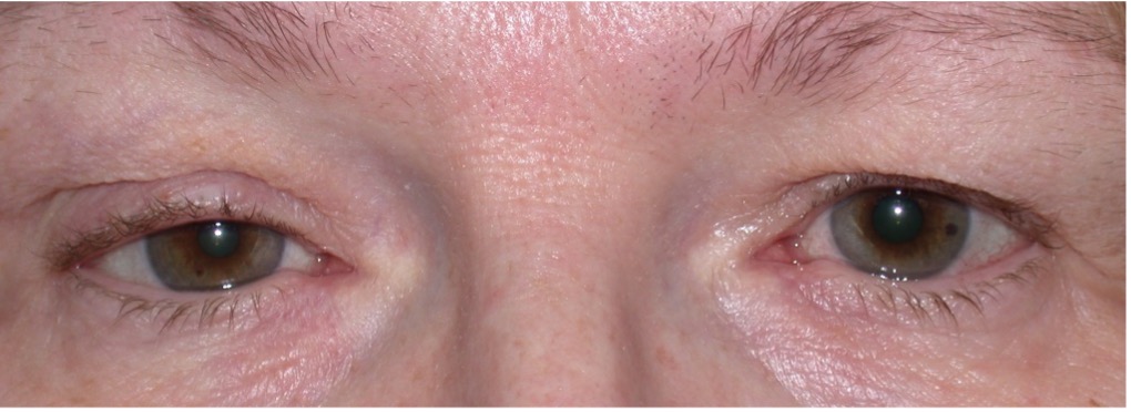 Horner’s Syndrome - Warwar Eye Group