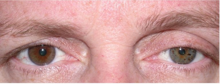 Horner’s Syndrome - Warwar Eye Group